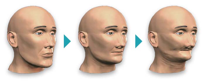 Jaw bone atrophy: classification, types and degrees